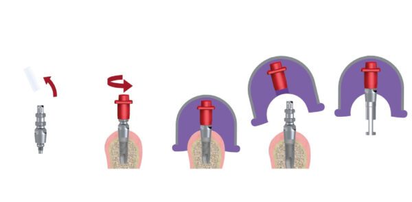 Simple Guide to Implant impression Coping techniques