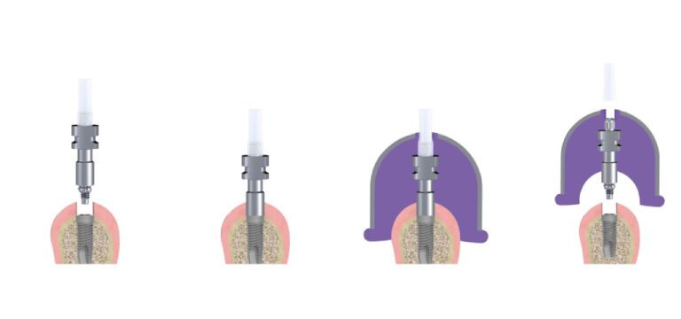 Simple Guide to Implant impression Coping techniques