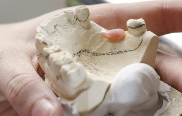 Maxilla & Mandible Bone Types | Dental Implant League Guide