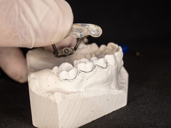Maxilla & Mandible Bone Types | Dental Implant League Guide