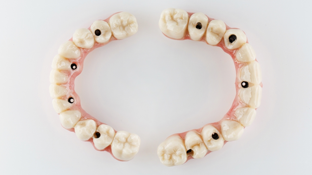 Cement and Screw Retained Implant Crown | Guide for Dentists